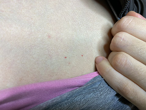 SPIDER VEIN / ANGIOMA